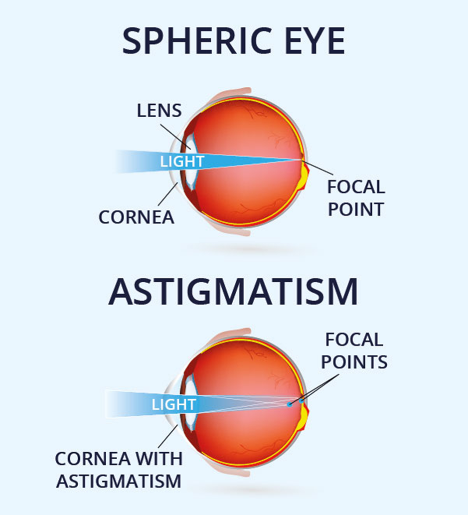What is Astigmatism? - Ojaimi Clinics